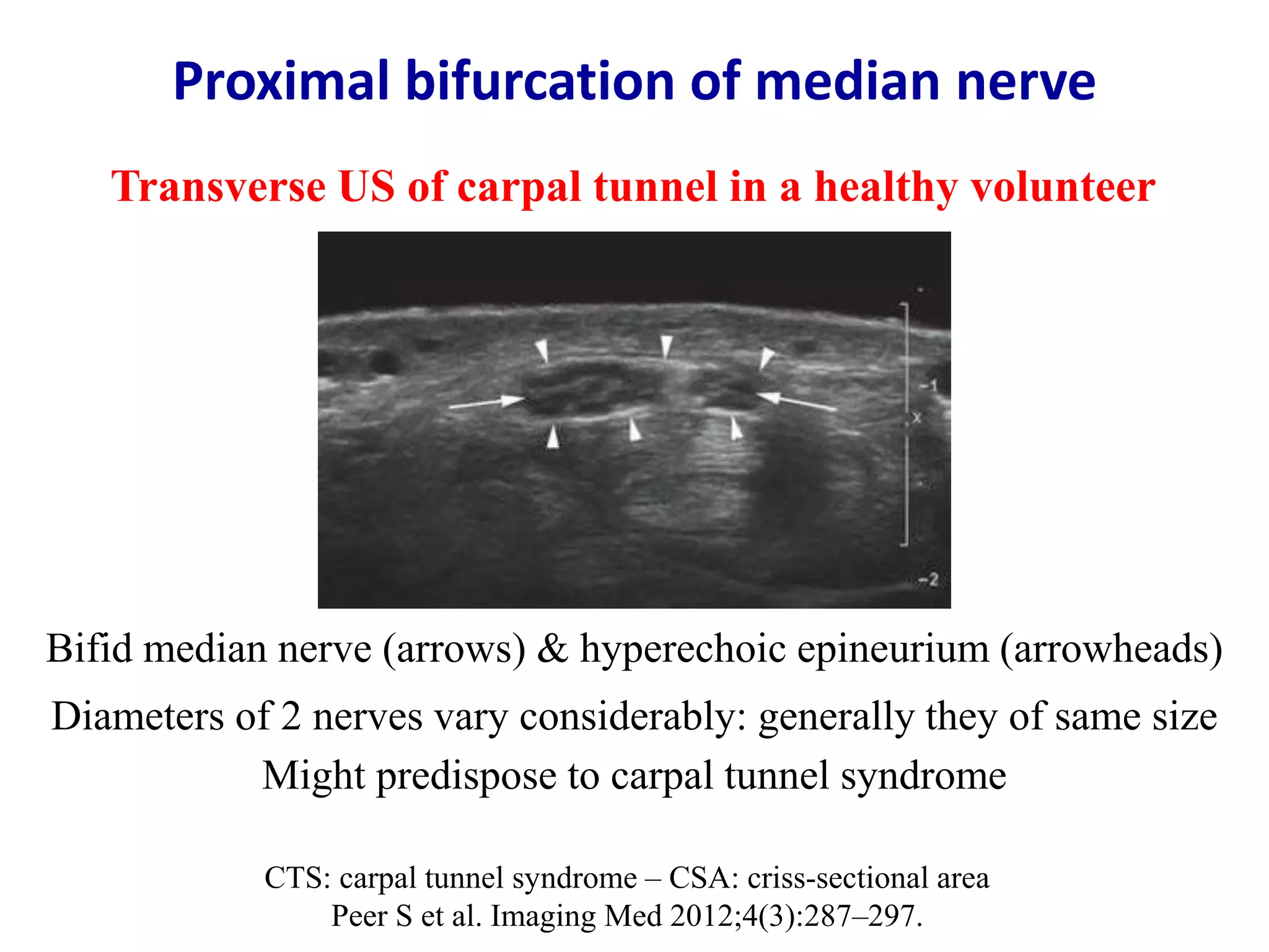 Ultrasound of carpal tunnel syndrome | PPTX