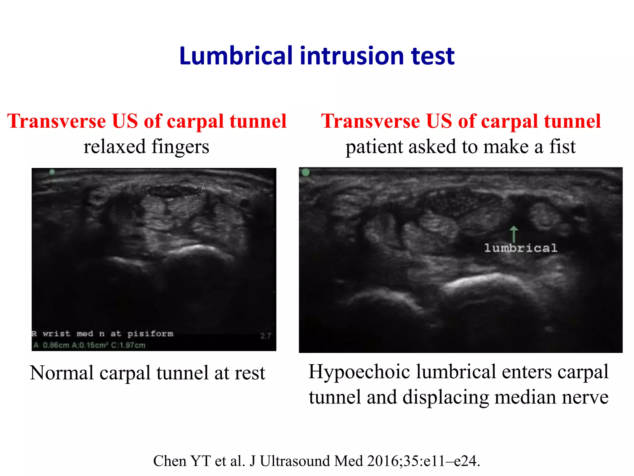 Ultrasound of carpal tunnel syndrome | PPTX
