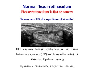 Ultrasound of carpal tunnel syndrome | PPTX