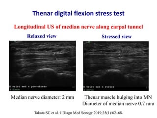 Ultrasound of carpal tunnel syndrome | PPTX