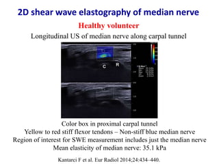 Ultrasound of carpal tunnel syndrome | PPTX
