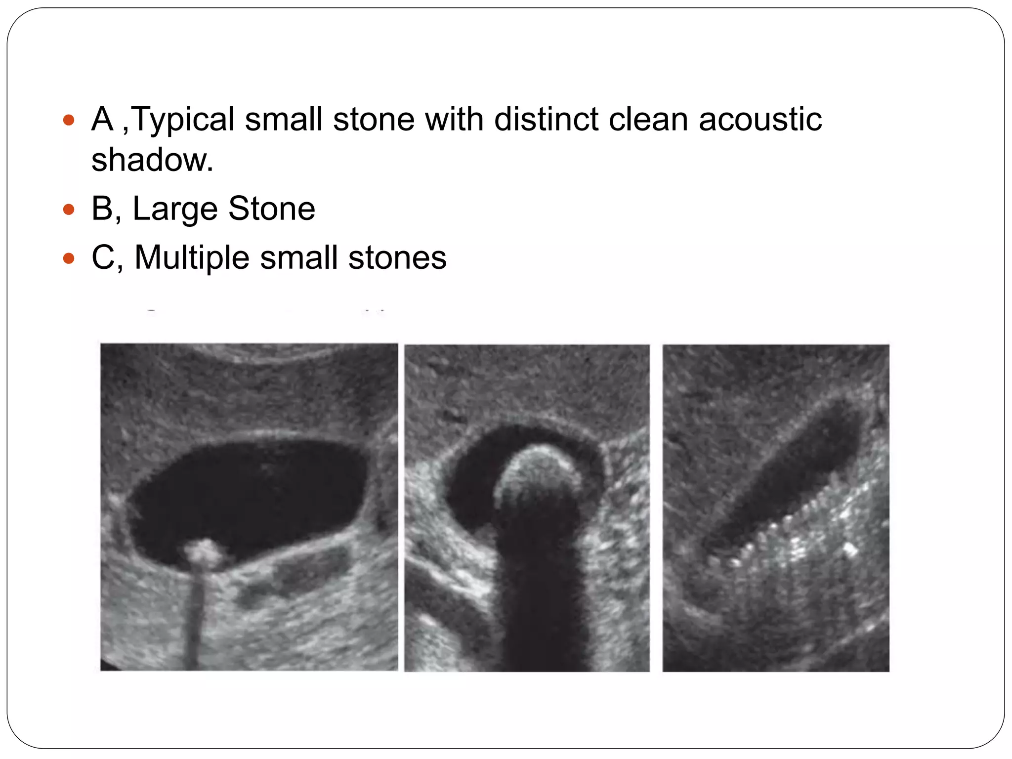 Ultrasound of gall bladder | PPTX