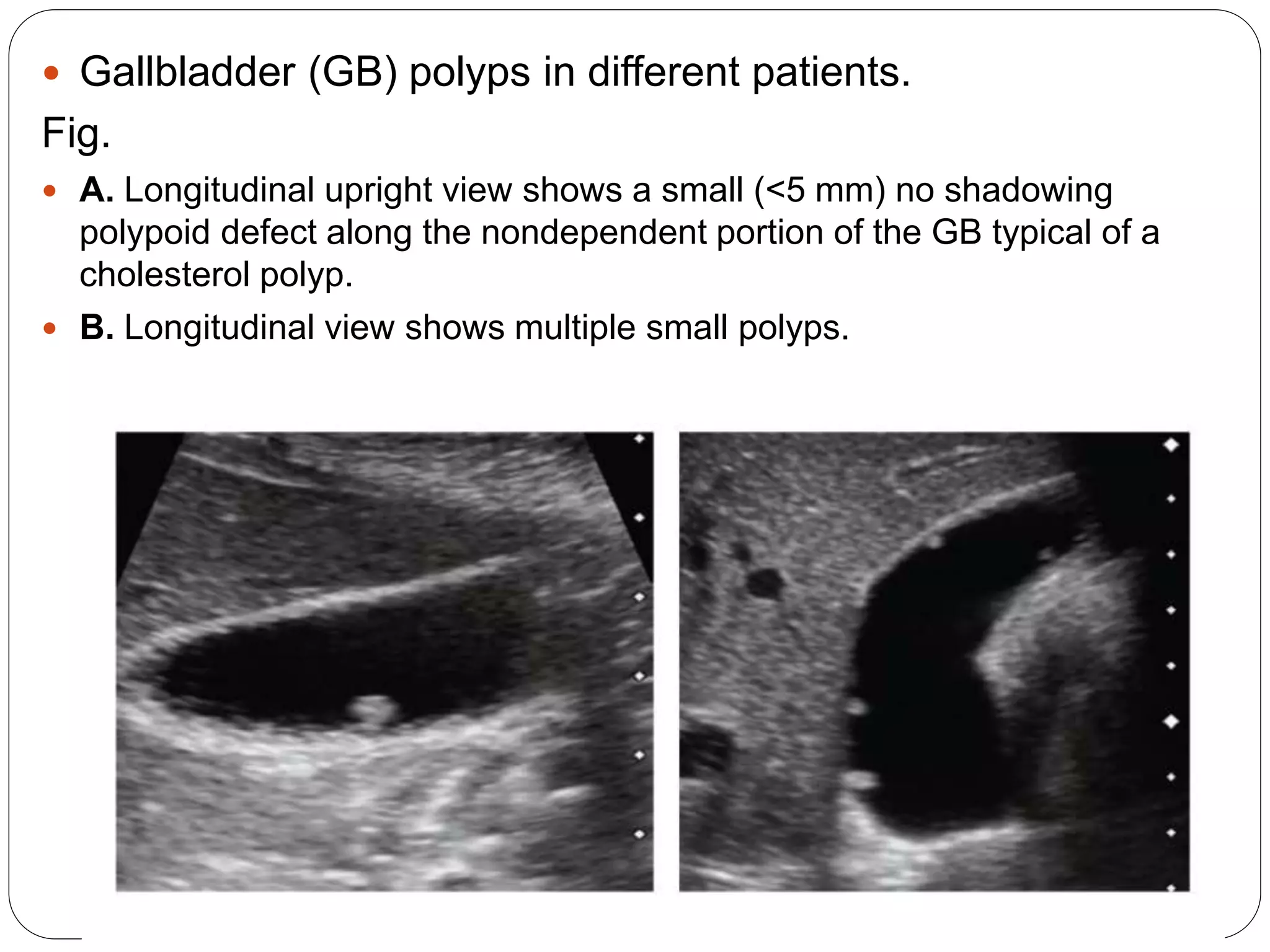 Ultrasound of gall bladder | PPTX