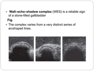 Ultrasound of gall bladder | PPTX
