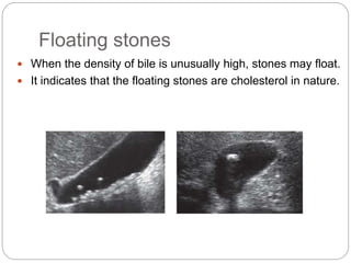 Ultrasound of gall bladder | PPTX