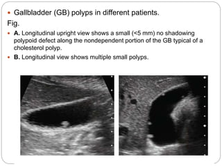 Ultrasound of gall bladder | PPTX