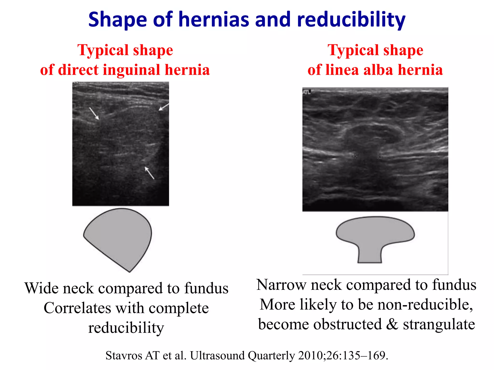 Ultrasound of groin & anterior abdominal wall hernias | PPTX