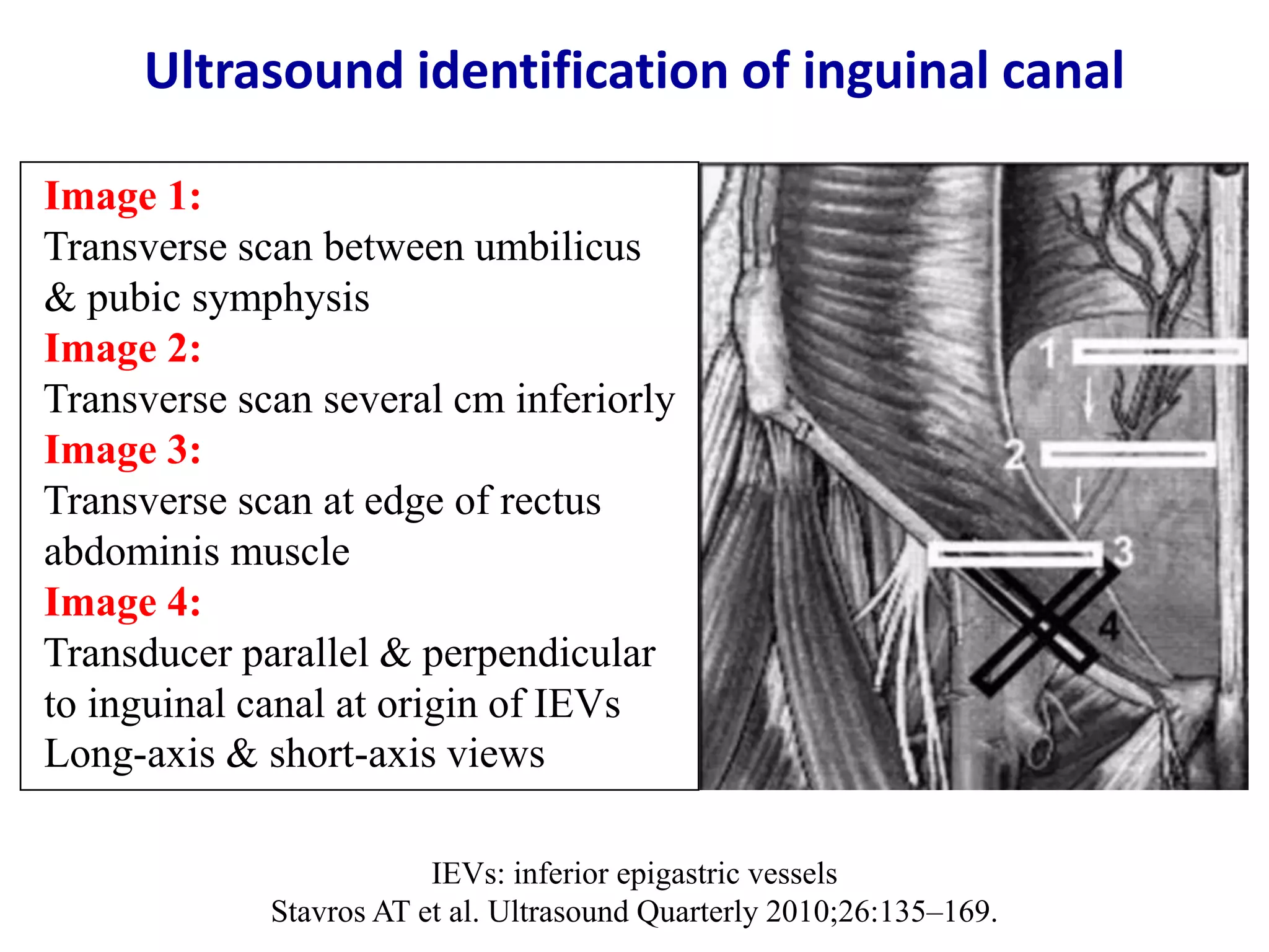 Ultrasound of groin & anterior abdominal wall hernias | PPTX