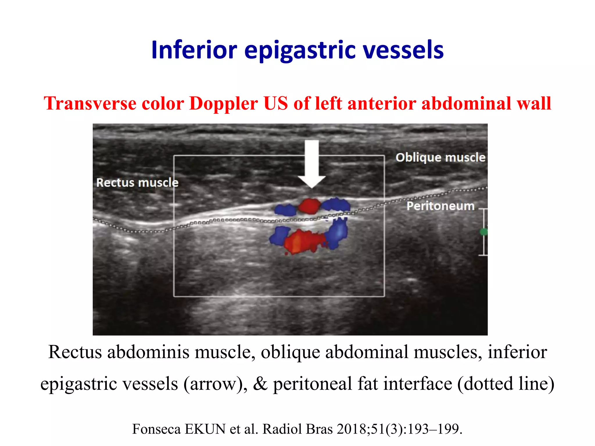 Ultrasound of groin & anterior abdominal wall hernias | PPTX
