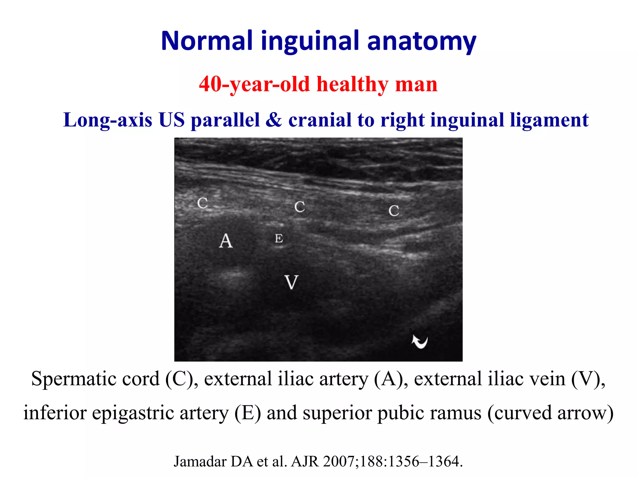 Ultrasound of groin & anterior abdominal wall hernias | PPTX