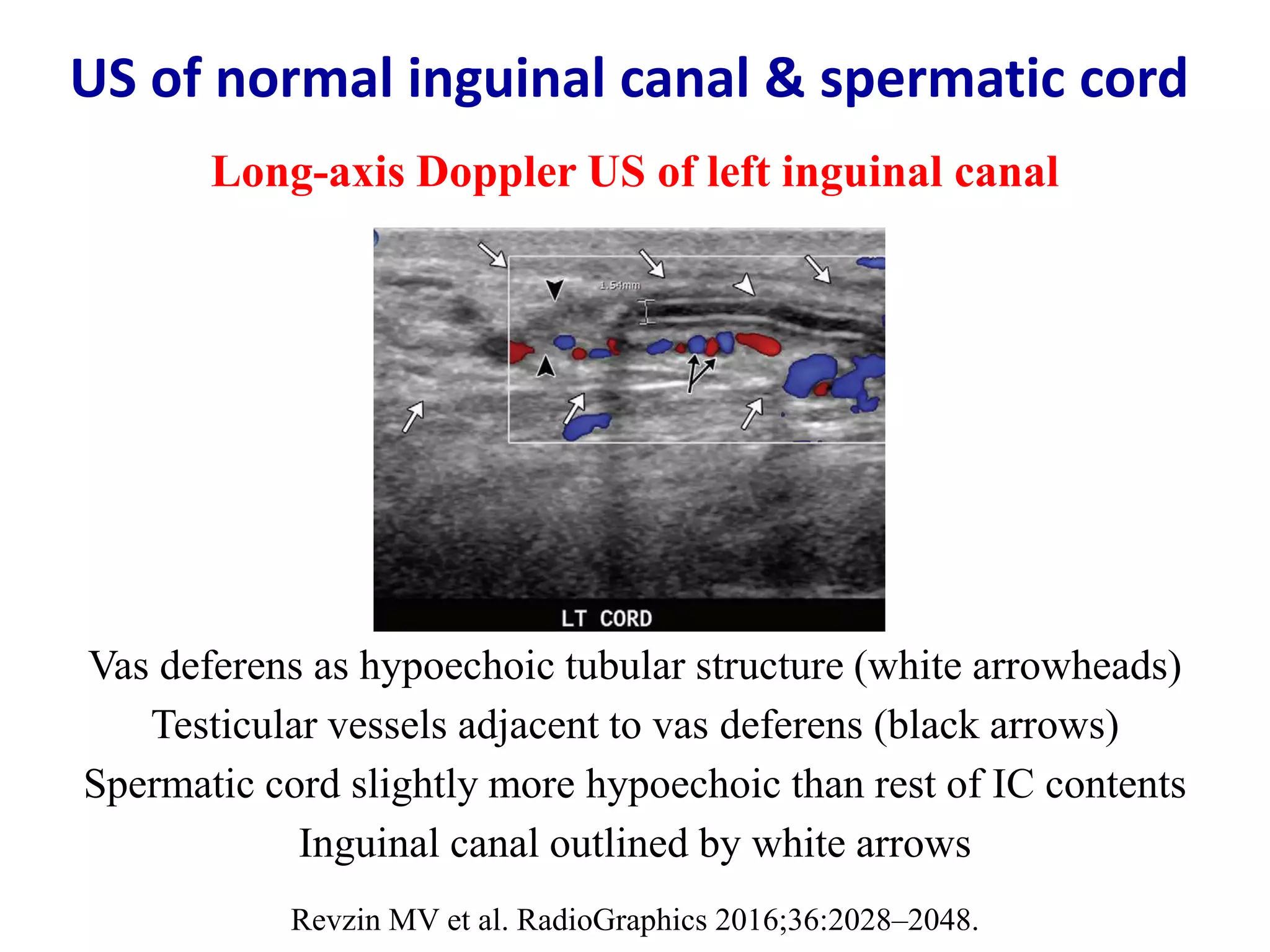 Ultrasound of groin & anterior abdominal wall hernias | PPTX