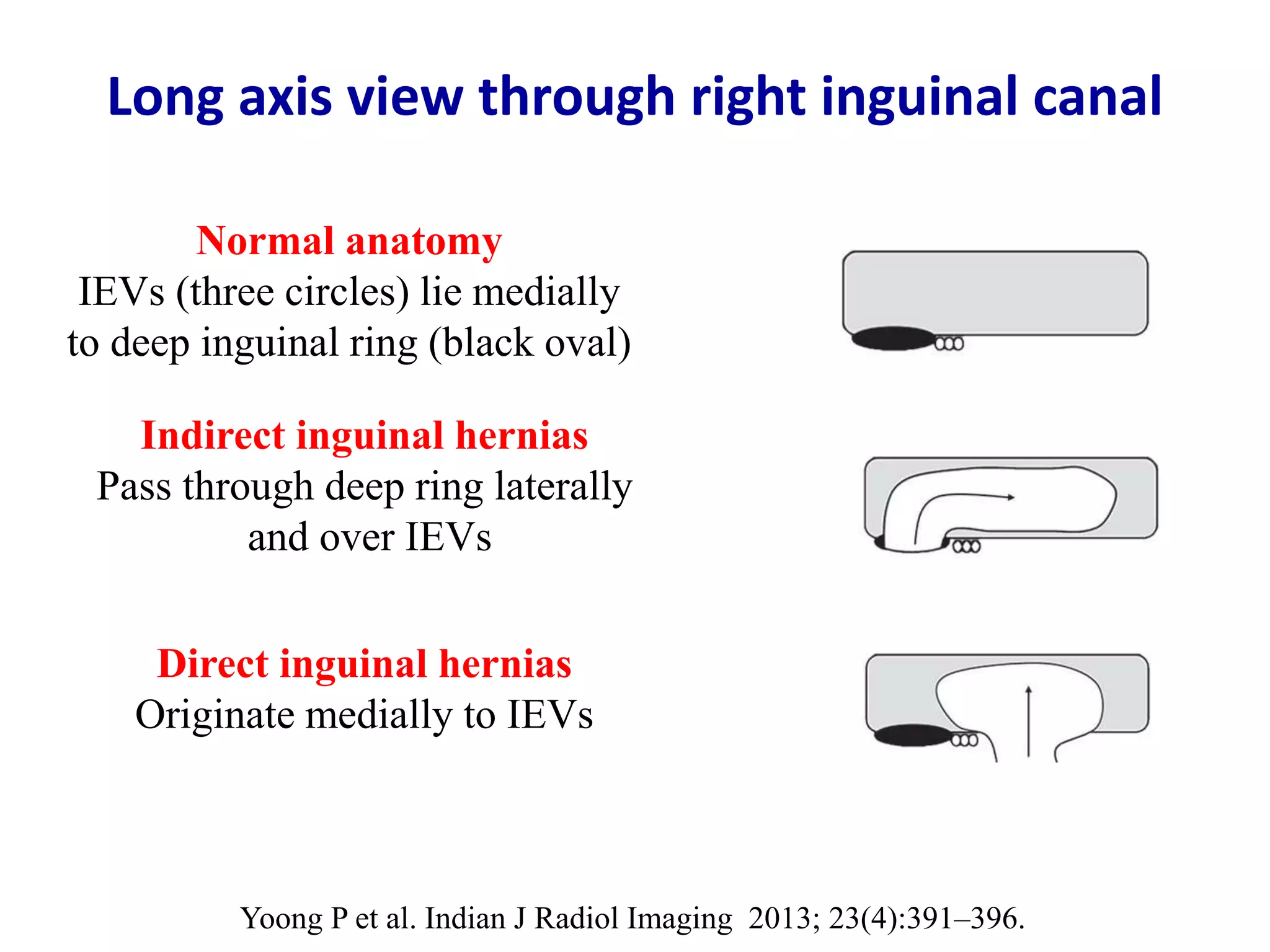 Ultrasound of groin & anterior abdominal wall hernias | PPTX