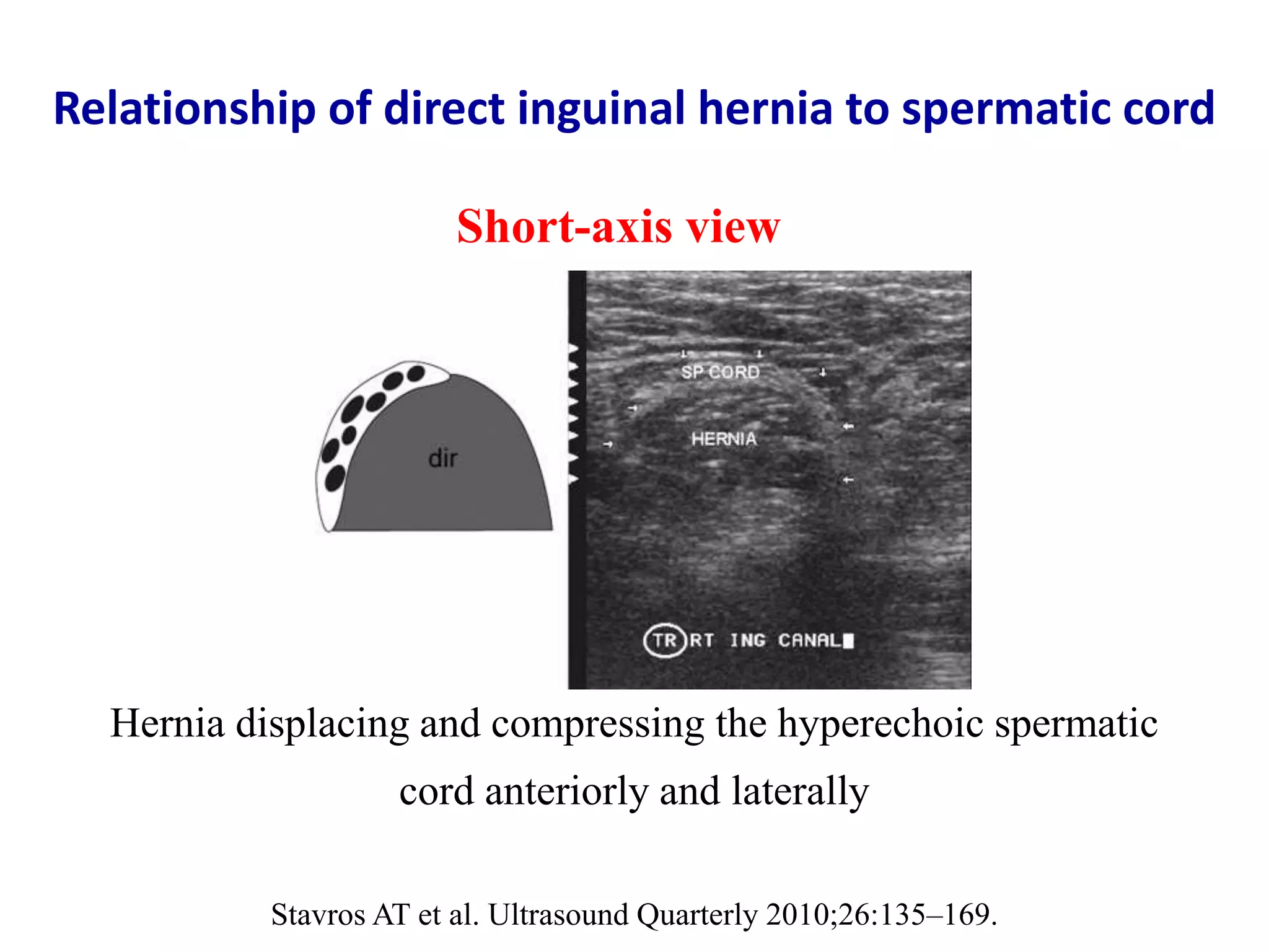 Ultrasound of groin & anterior abdominal wall hernias | PPTX