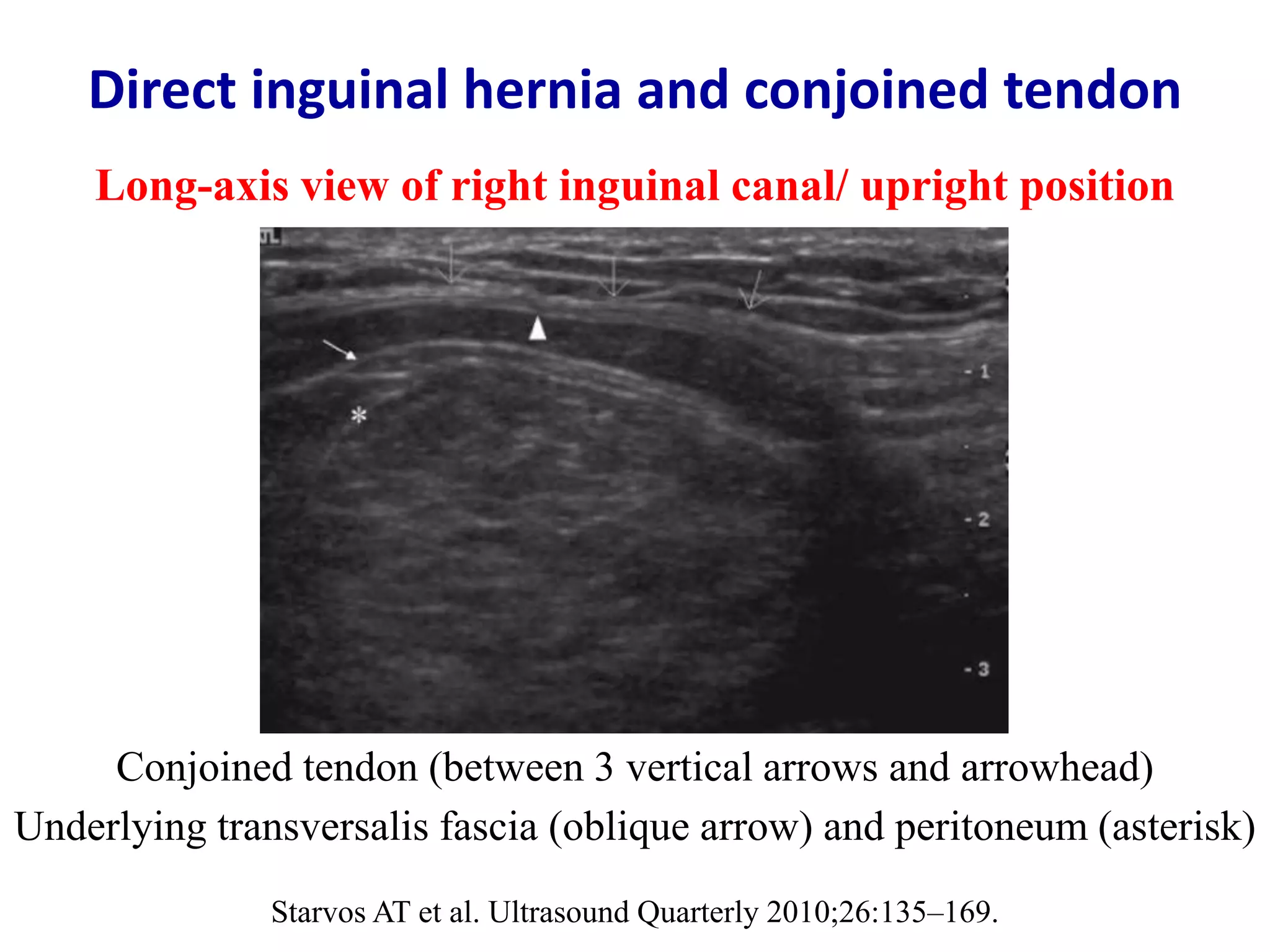 Ultrasound of groin & anterior abdominal wall hernias | PPTX