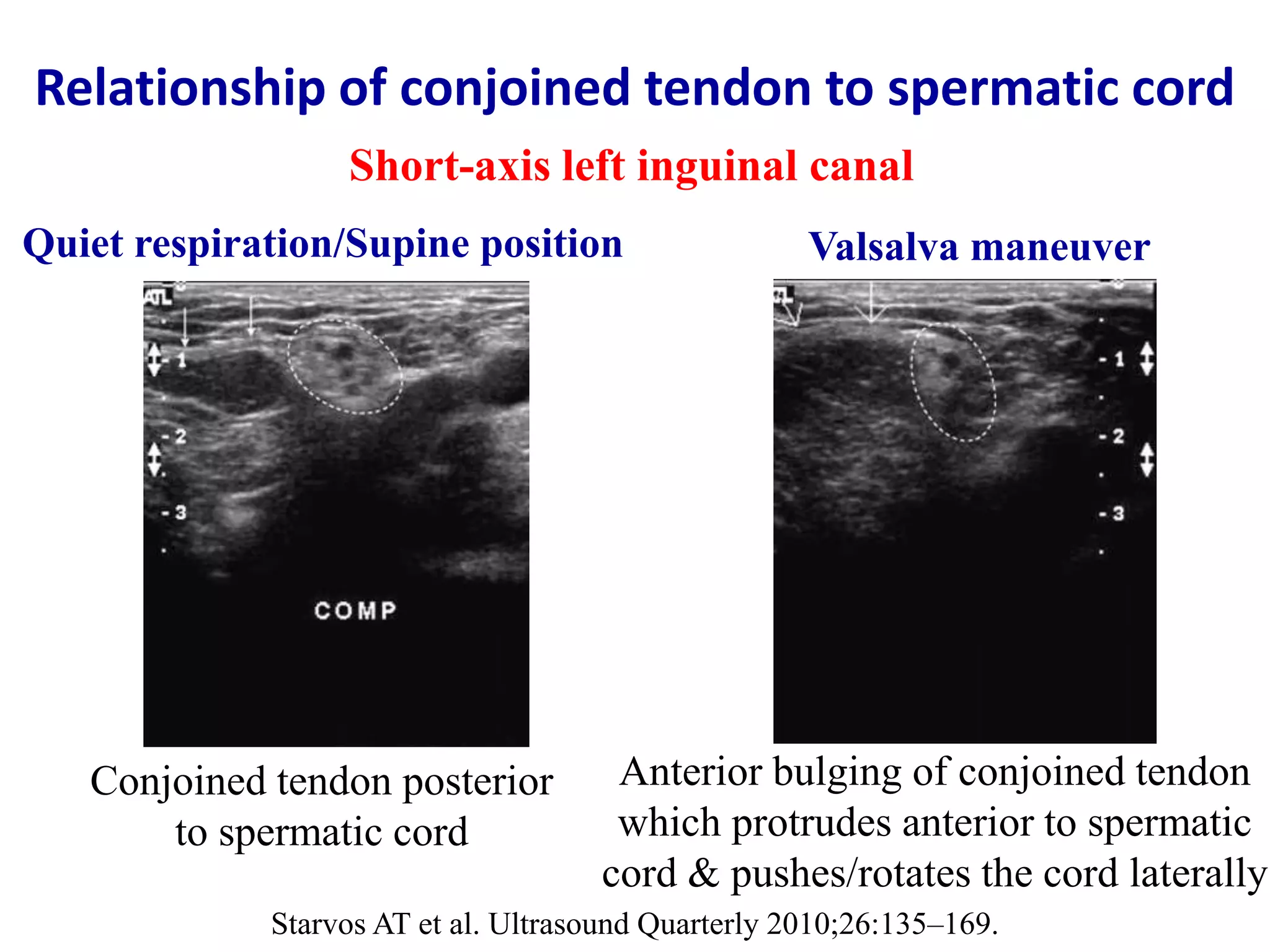 Ultrasound of groin & anterior abdominal wall hernias | PPTX