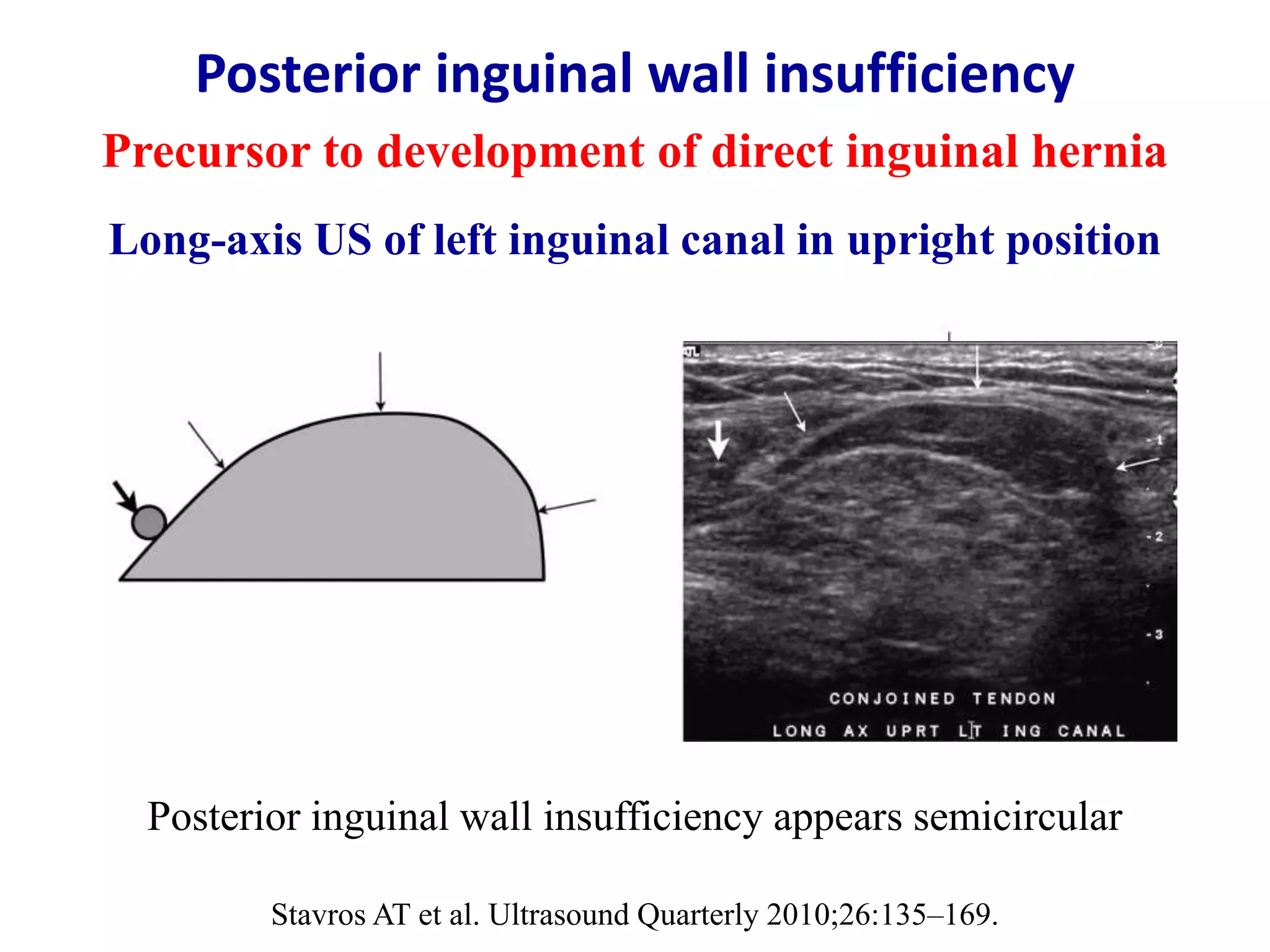 Ultrasound of groin & anterior abdominal wall hernias | PPTX