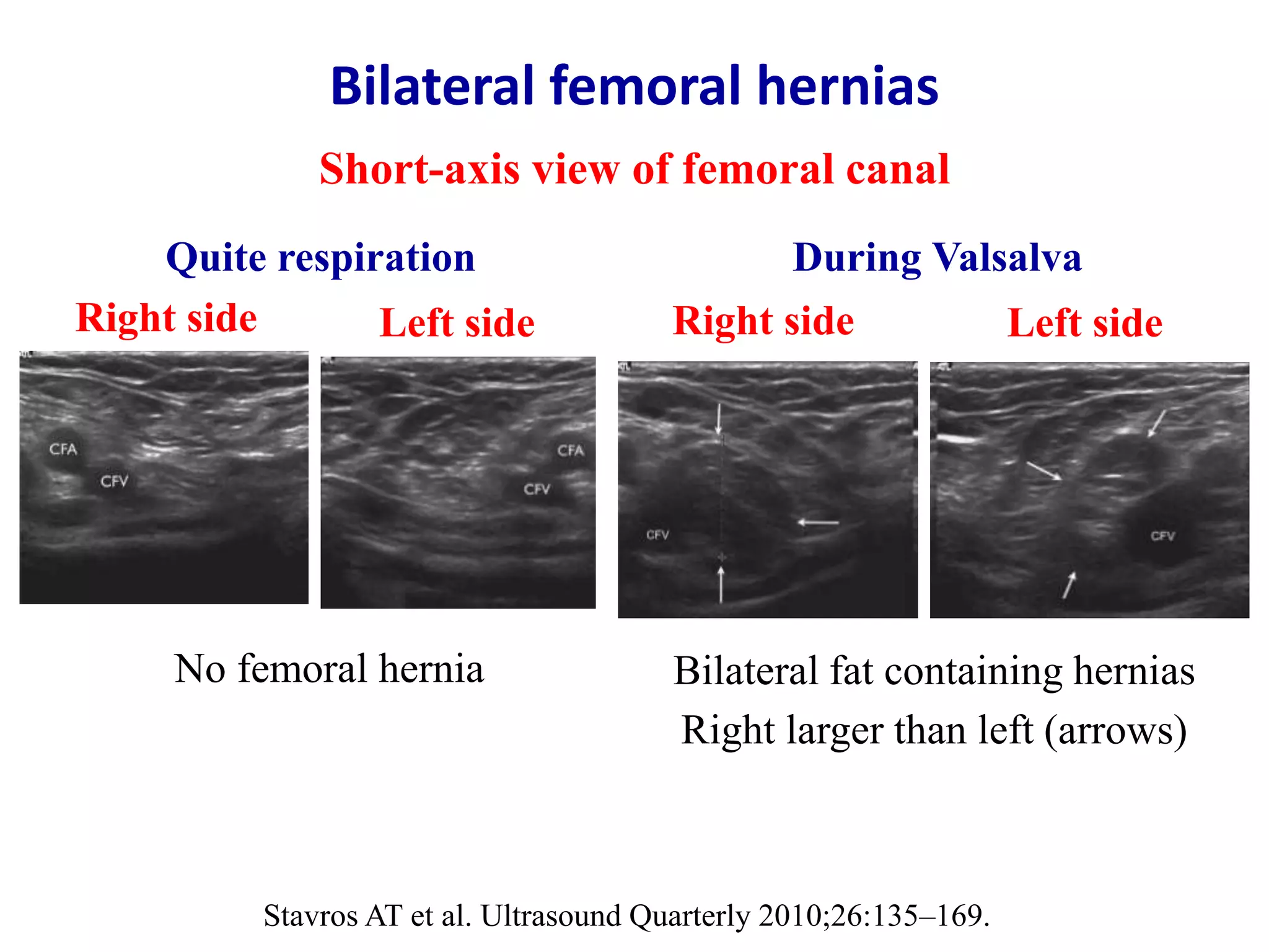 Ultrasound of groin & anterior abdominal wall hernias | PPTX