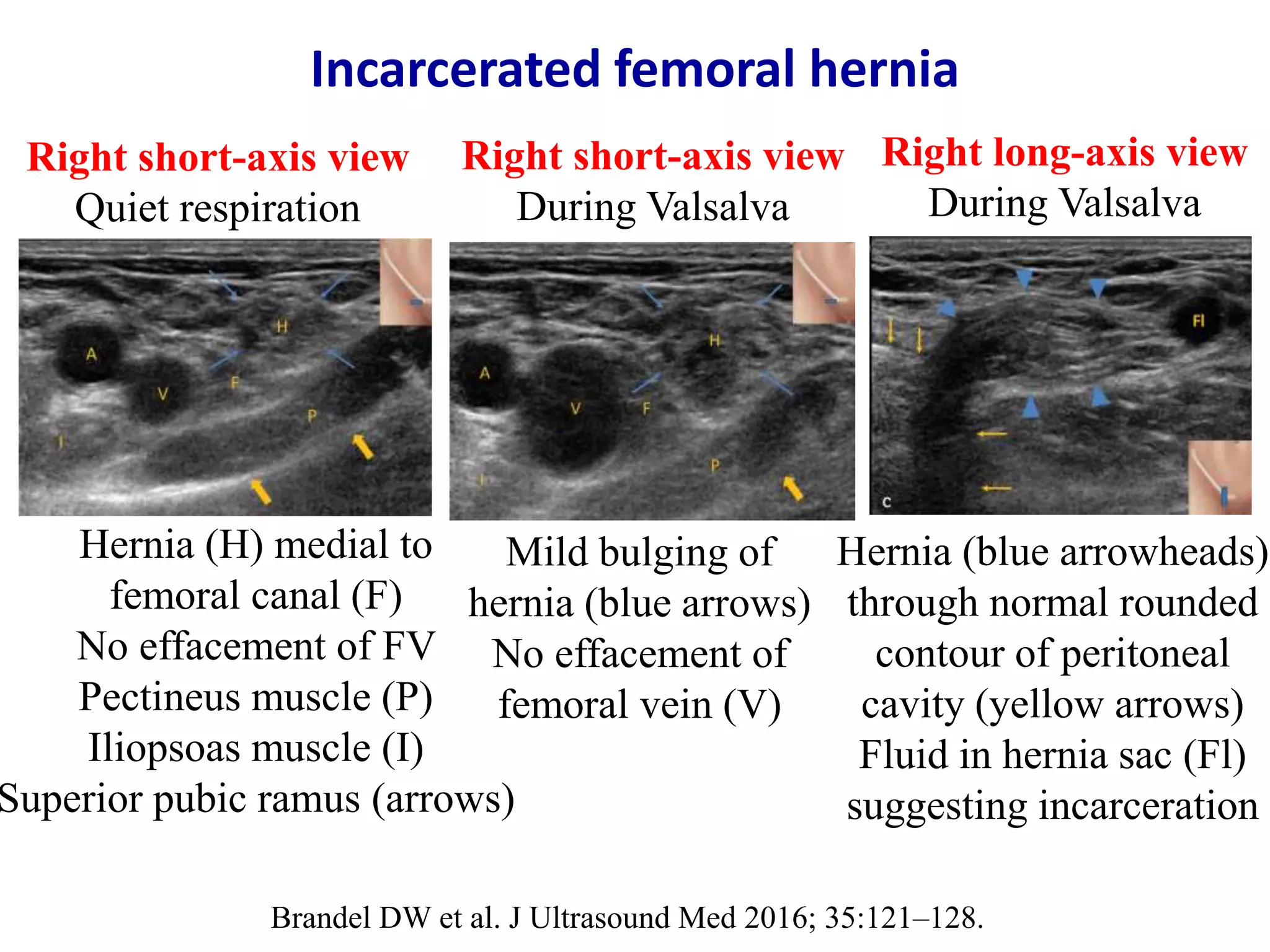 Ultrasound of groin & anterior abdominal wall hernias | PPTX