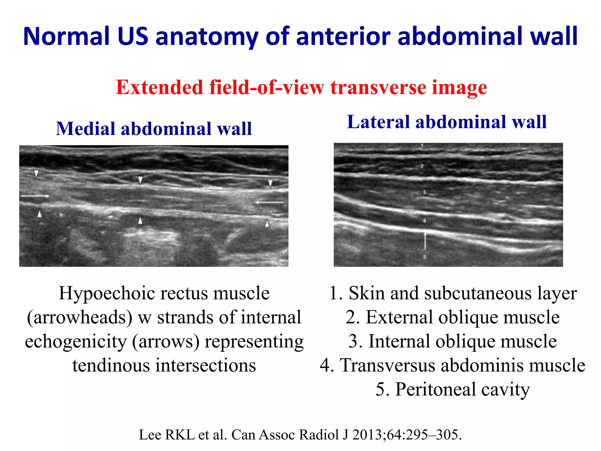 Ultrasound of groin & anterior abdominal wall hernias | PPTX
