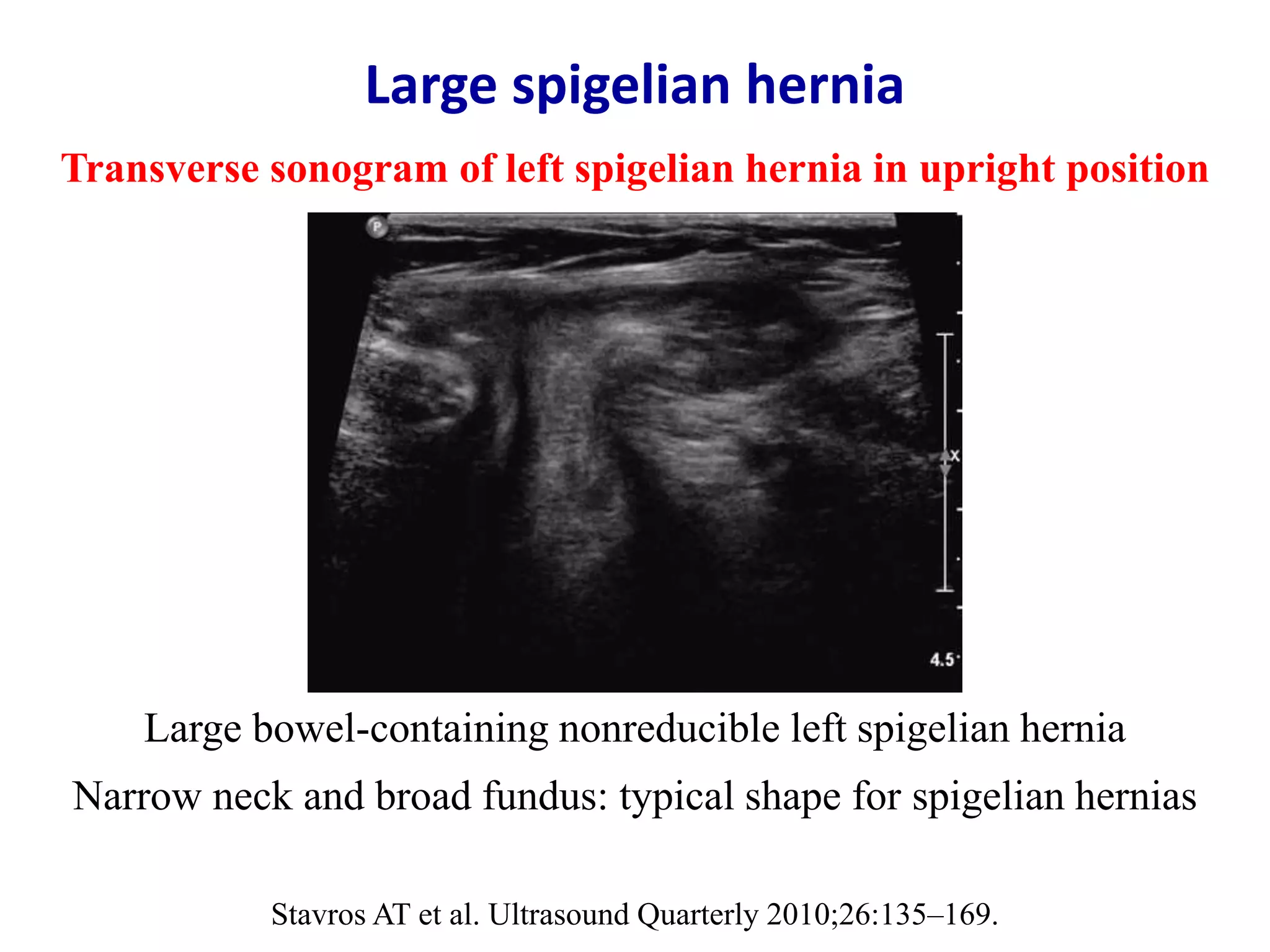 Ultrasound of groin & anterior abdominal wall hernias | PPTX