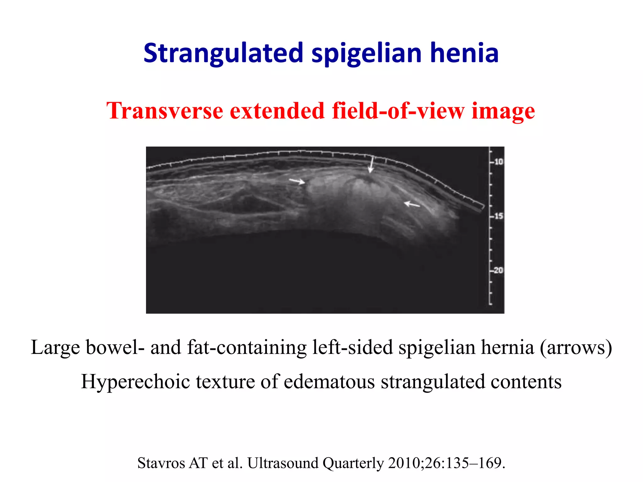 Ultrasound of groin & anterior abdominal wall hernias | PPTX