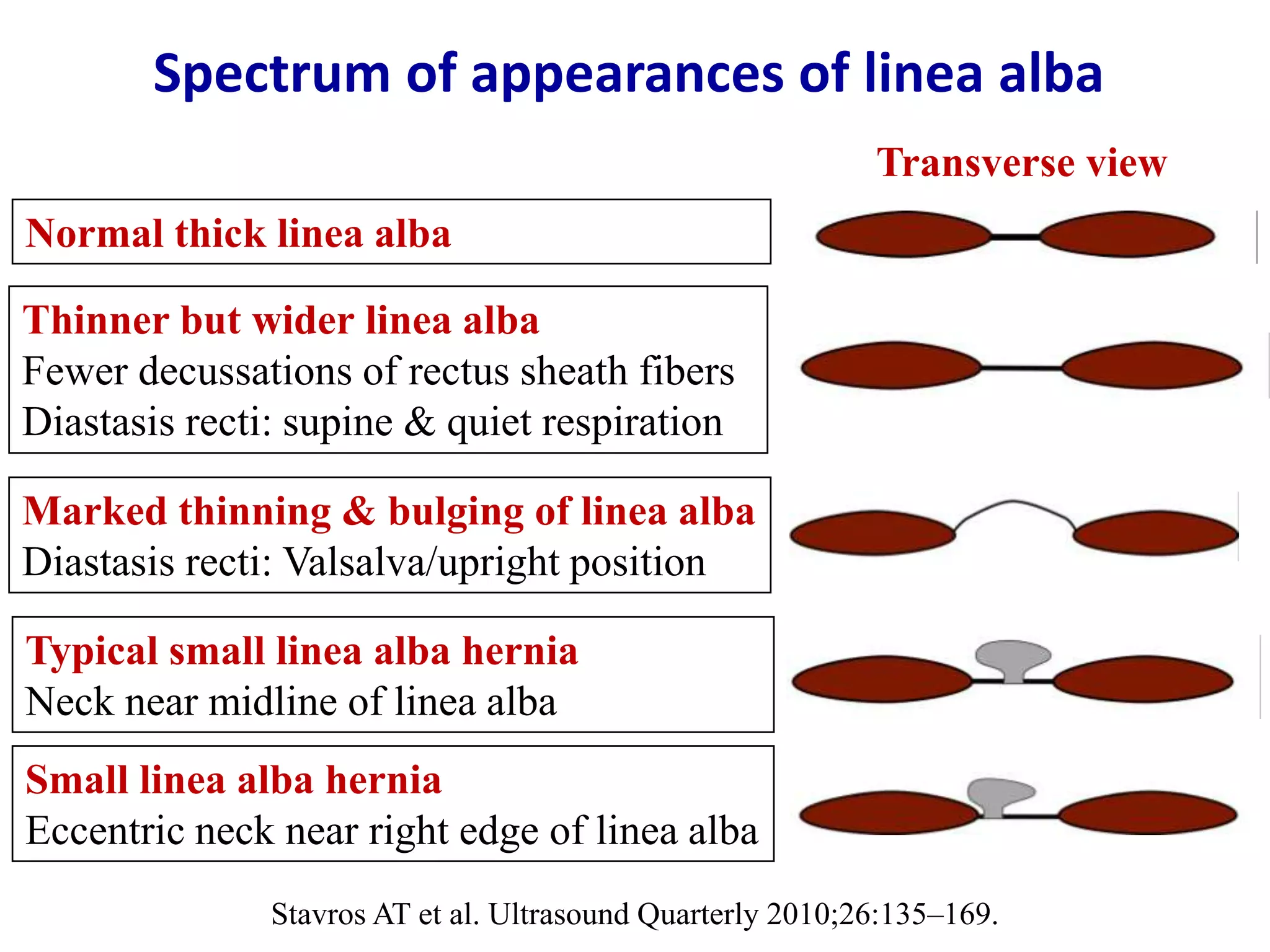 Ultrasound of groin & anterior abdominal wall hernias | PPTX