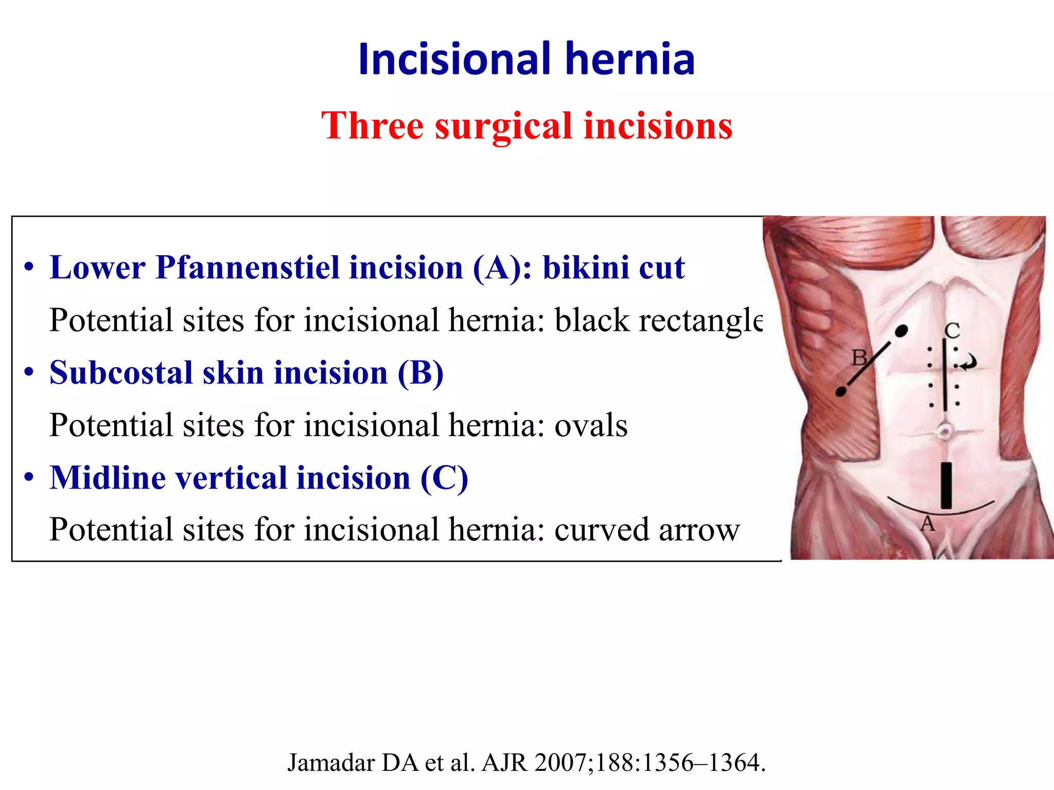 Ultrasound of groin & anterior abdominal wall hernias | PPTX