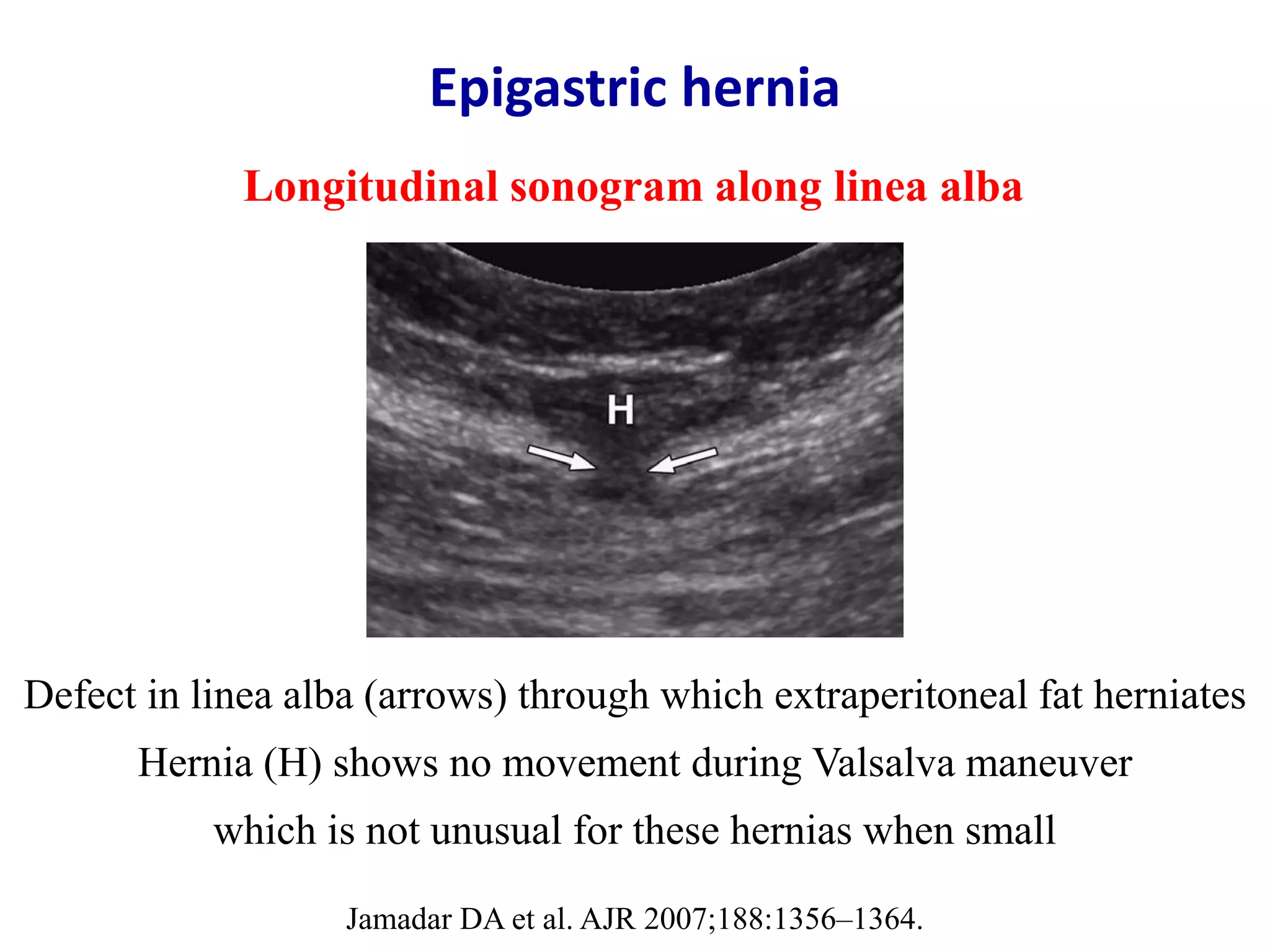 Ultrasound of groin & anterior abdominal wall hernias | PPTX