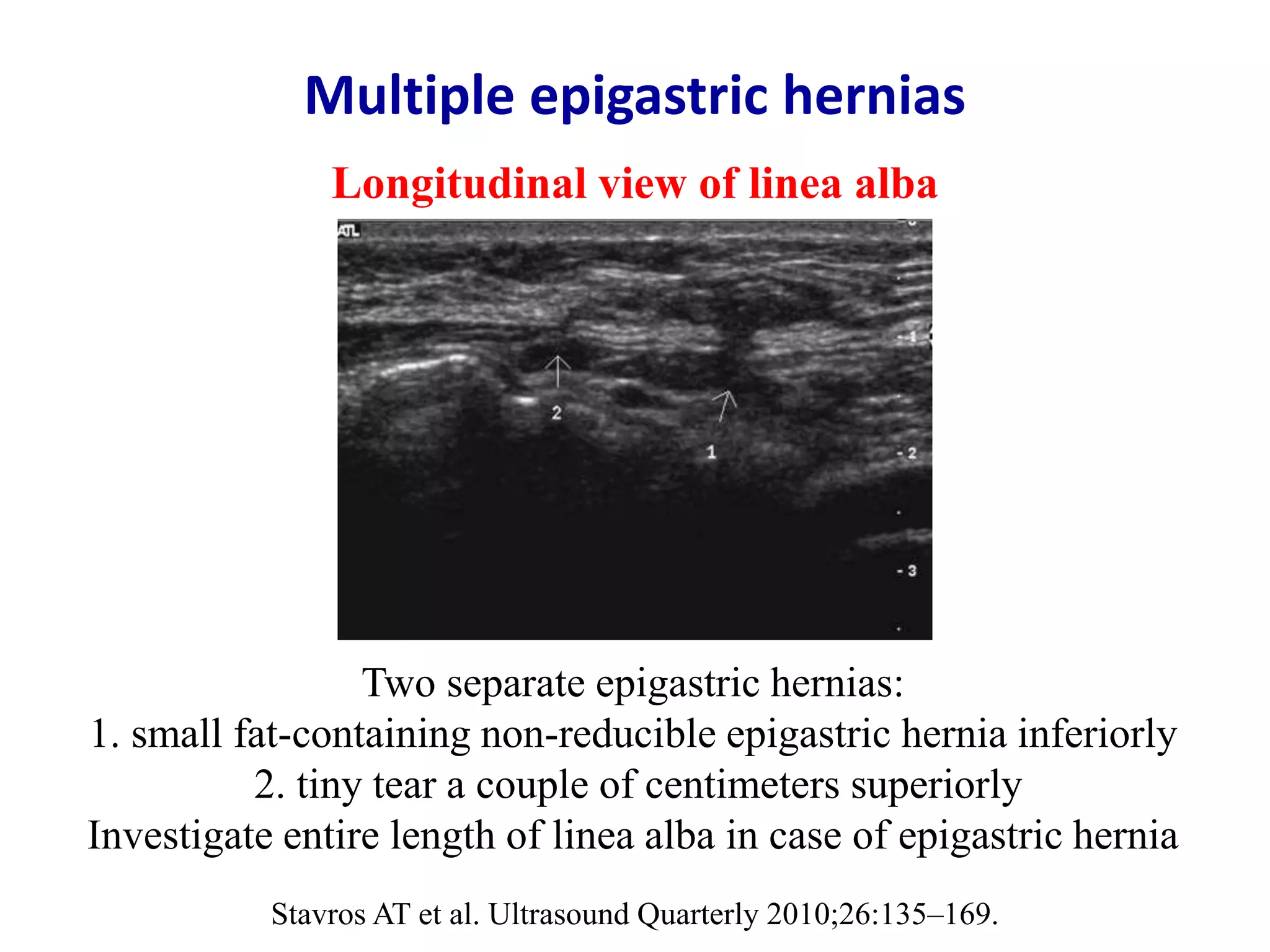 Ultrasound of groin & anterior abdominal wall hernias | PPTX
