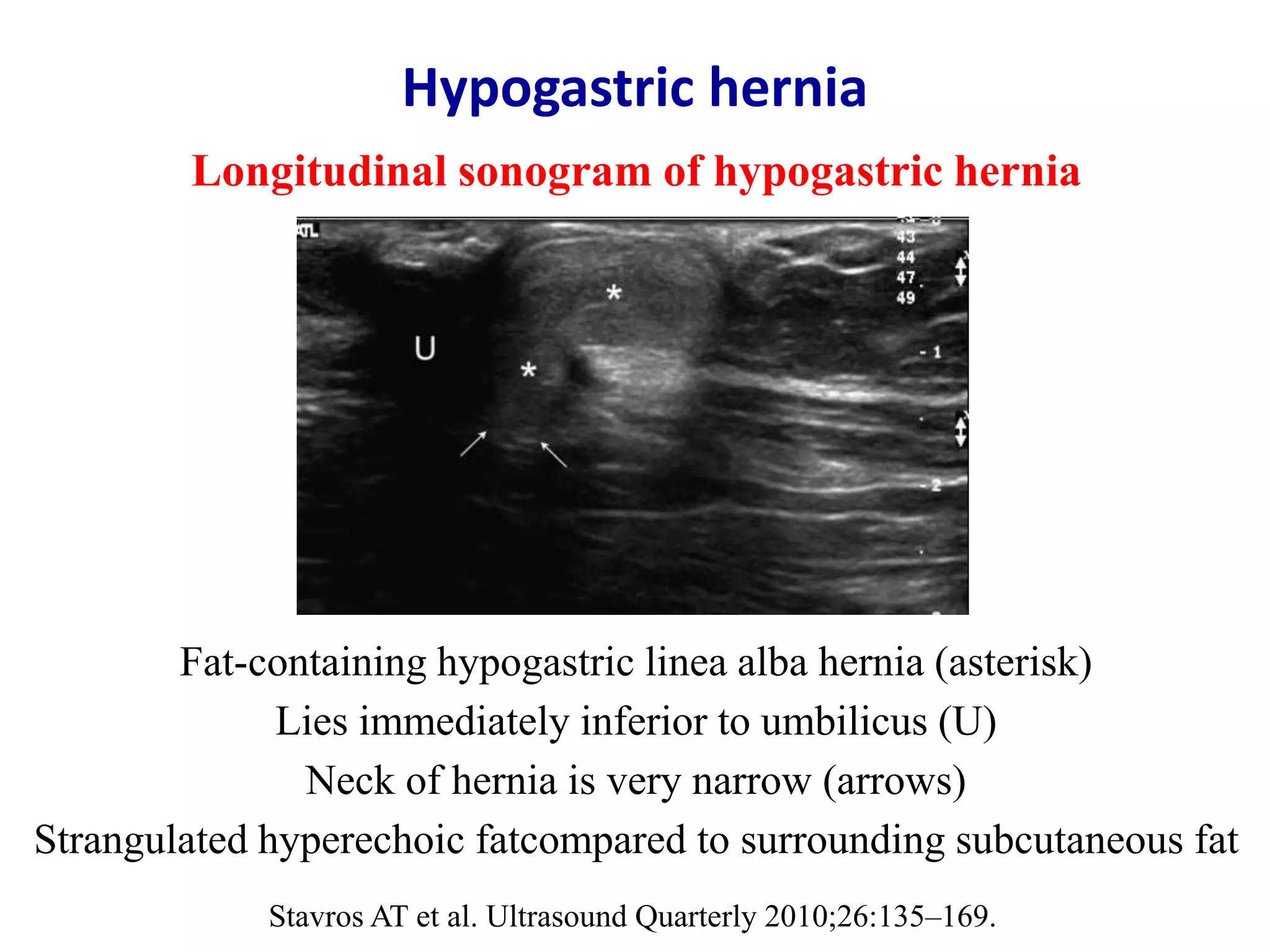 Ultrasound of groin & anterior abdominal wall hernias | PPTX