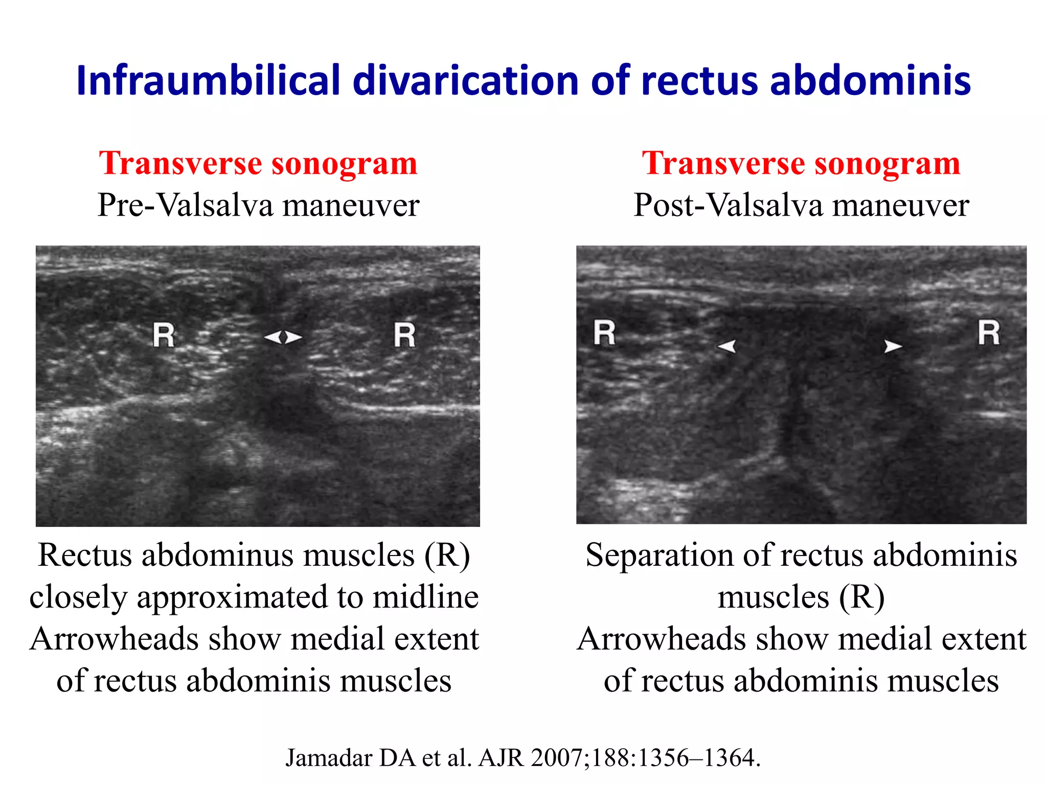 Ultrasound of groin & anterior abdominal wall hernias | PPTX