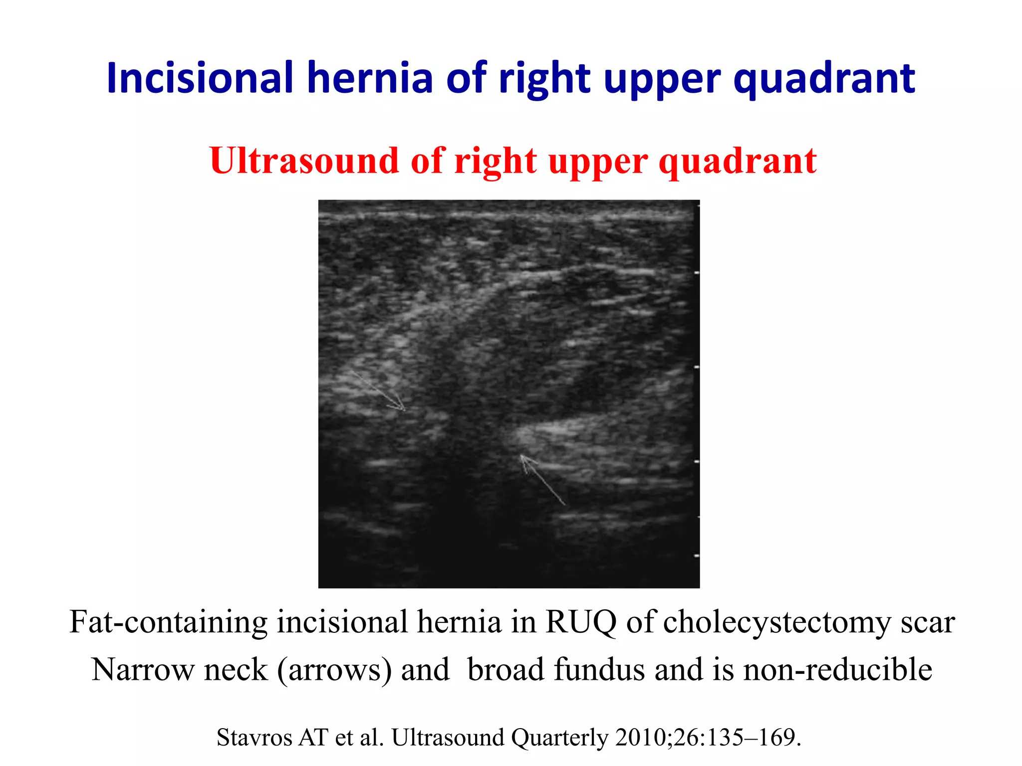 Ultrasound of groin & anterior abdominal wall hernias | PPTX