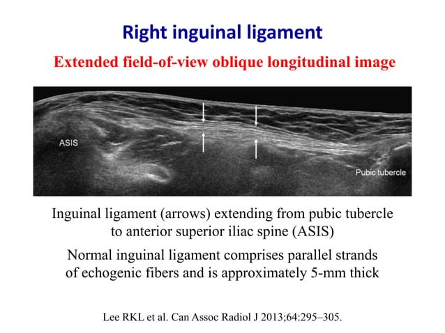 Ultrasound of groin & anterior abdominal wall hernias | PPTX | Death ...