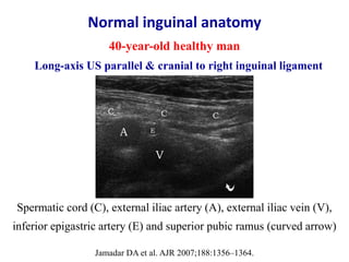 Ultrasound of groin & anterior abdominal wall hernias | PPTX