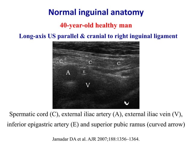 Ultrasound of groin & anterior abdominal wall hernias | PPTX | Death ...
