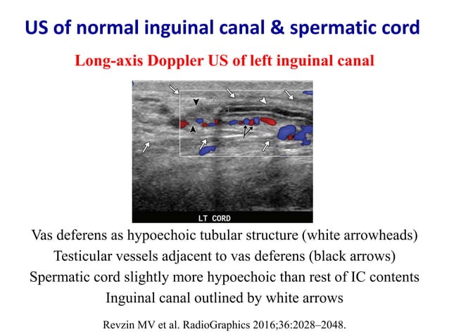 Ultrasound of groin & anterior abdominal wall hernias | PPTX | Death ...