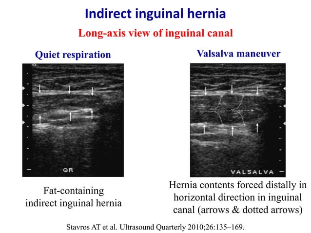 Ultrasound of groin & anterior abdominal wall hernias | PPTX | Death ...
