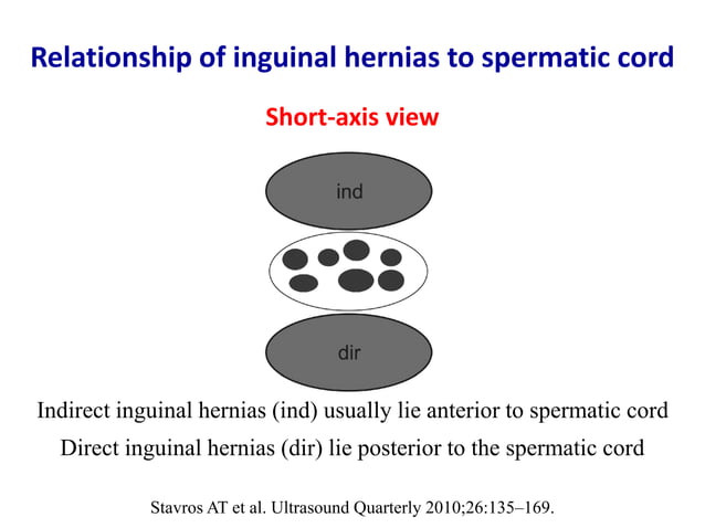 Ultrasound of groin & anterior abdominal wall hernias | PPTX | Death ...