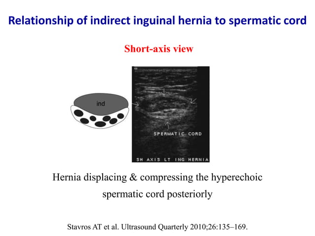 Ultrasound of groin & anterior abdominal wall hernias | PPTX | Death ...