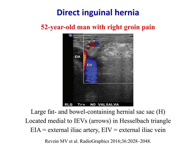 Ultrasound of groin & anterior abdominal wall hernias | PPTX | Death ...