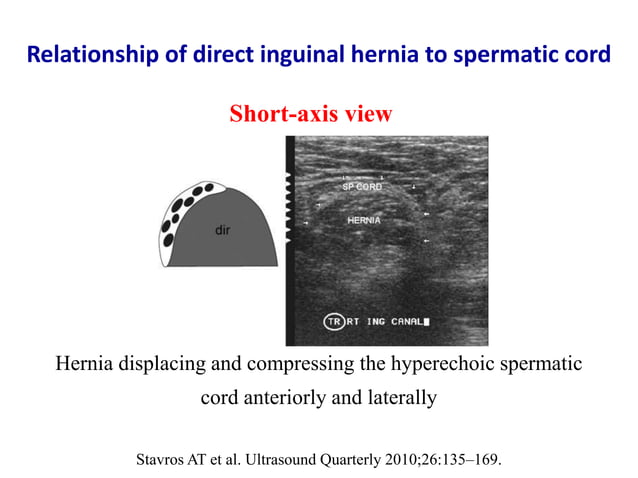 Ultrasound of groin & anterior abdominal wall hernias | PPTX | Death ...