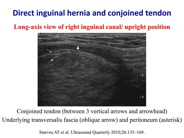 Ultrasound of groin & anterior abdominal wall hernias | PPTX | Death ...
