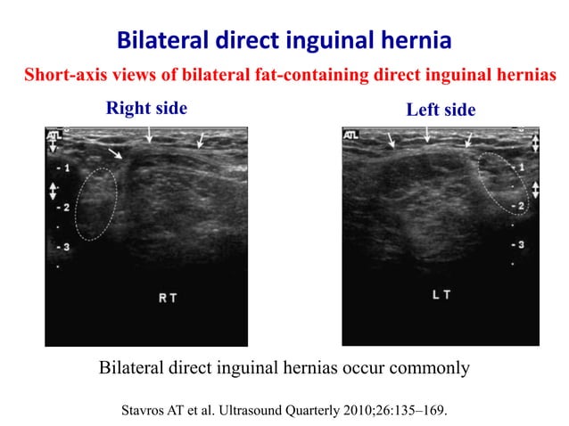 Ultrasound of groin & anterior abdominal wall hernias | PPTX | Death ...