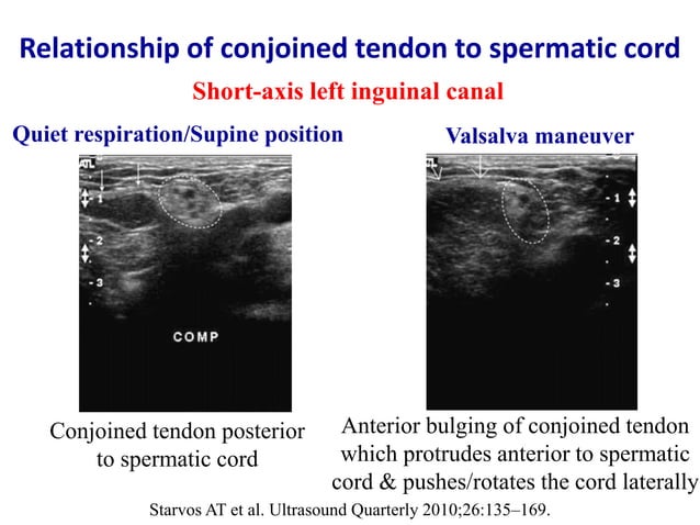 Ultrasound of groin & anterior abdominal wall hernias | PPTX | Death ...