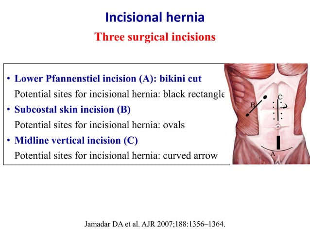Ultrasound of groin & anterior abdominal wall hernias | PPTX | Death ...