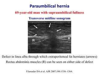 Ultrasound of groin & anterior abdominal wall hernias | PPTX