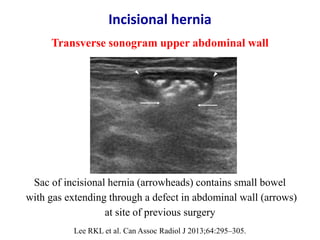 Ultrasound of groin & anterior abdominal wall hernias | PPTX