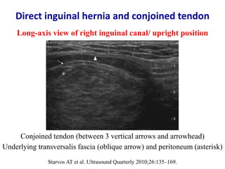 Direct Inguinal Hernia Ultrasound