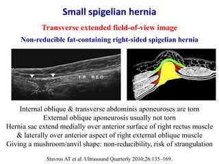 Spigelian Hernia Ultrasound