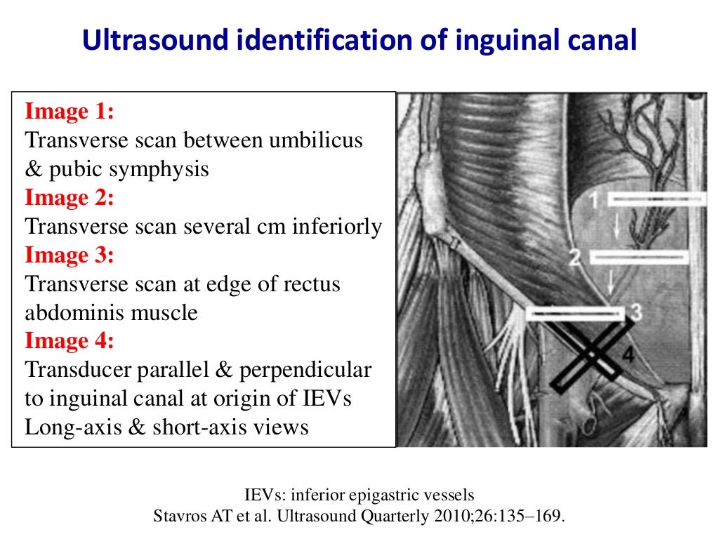 Ultrasound of groin & anterior abdominal wall hernias